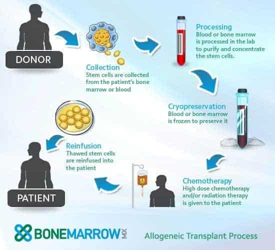 Allogeneic Stem Cell Transplantation UAMS Stem Cell Transplantation